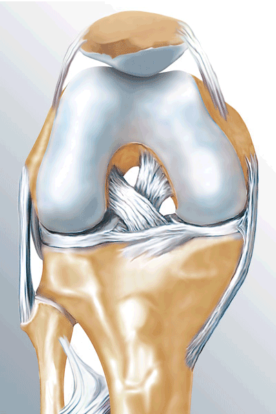 Osteoarthritis of the knee