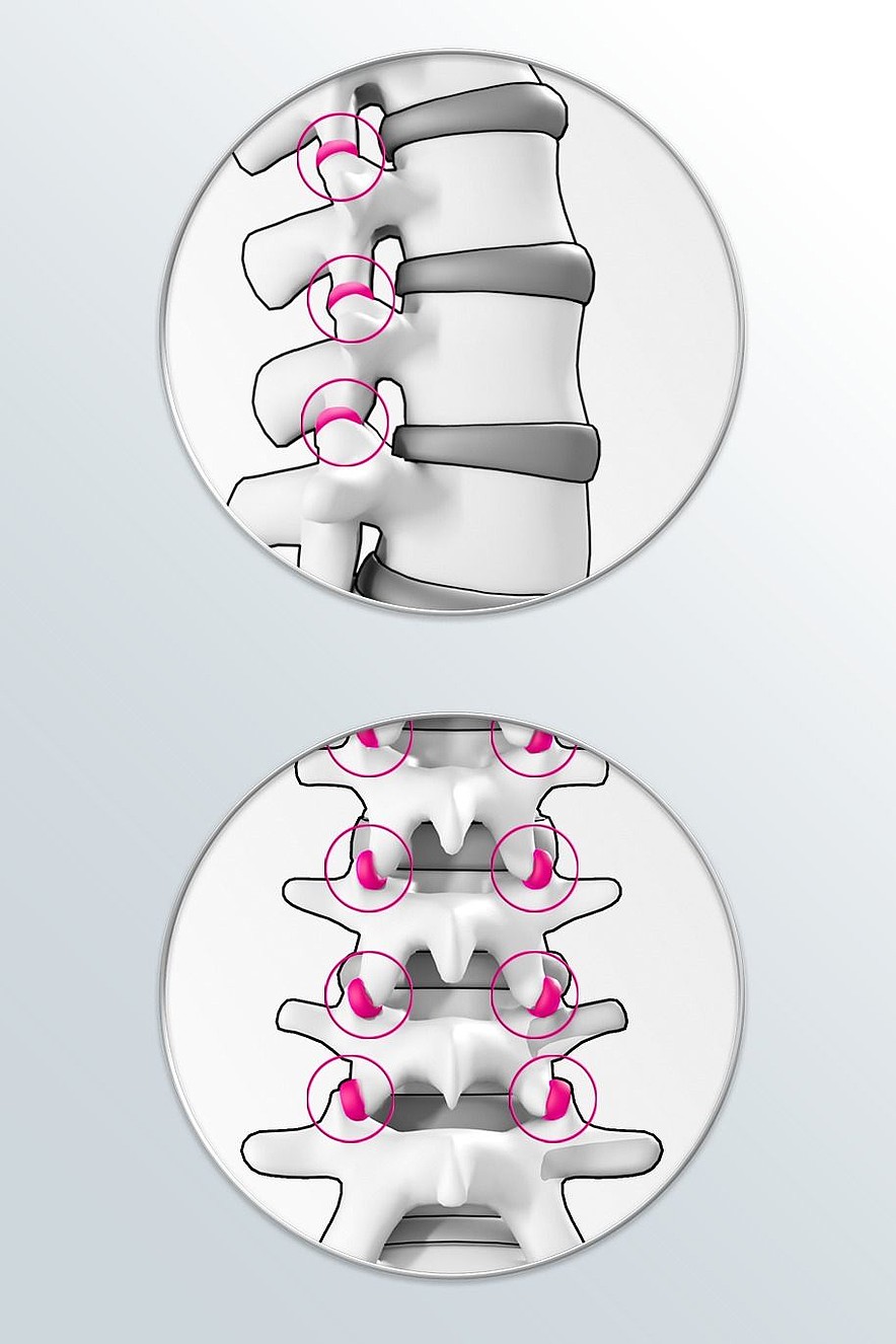 Joints between the vertebrae (facet joints)